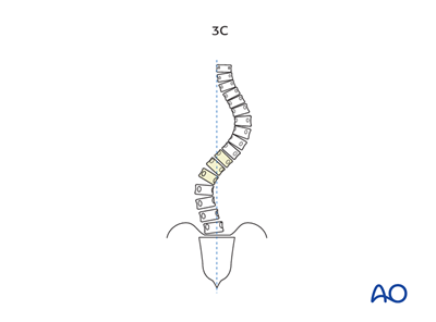 Selection of fusion level