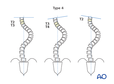 Selection of fusion level