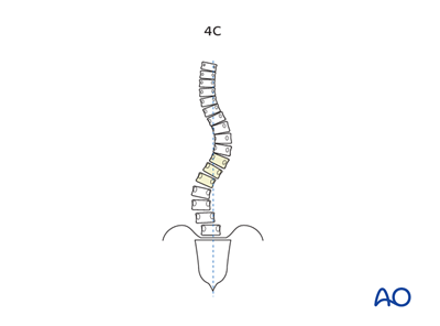 Selection of fusion level
