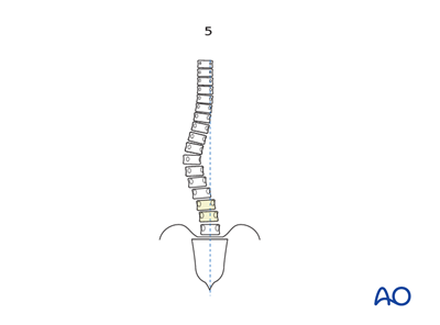 Selection of fusion level