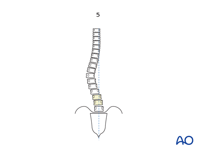 Selection of fusion level