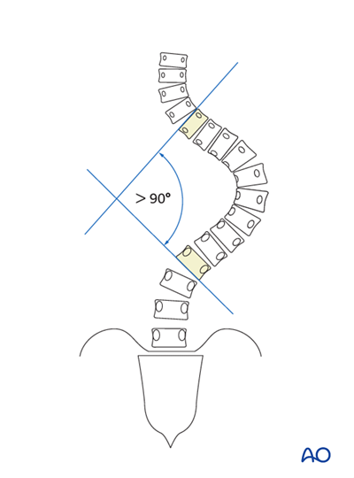 Management of large curves in the spine