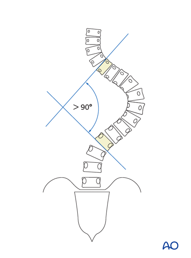 Management of large curves in the spine