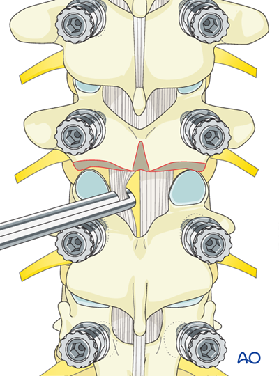Posterior Screws - With direct vertebral body derotation for Lenke 6