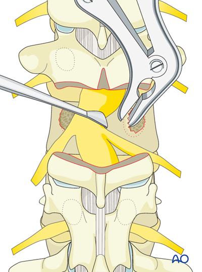 Management of large curves in the spine