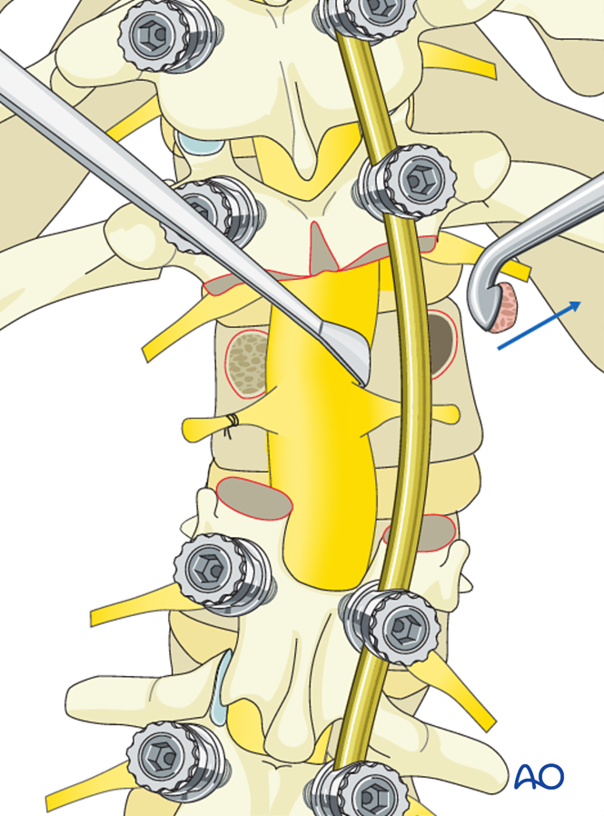 Management of large curves in the spine
