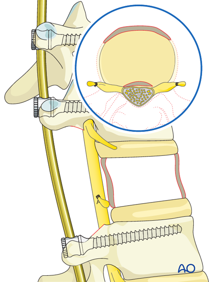 Management of large curves in the spine