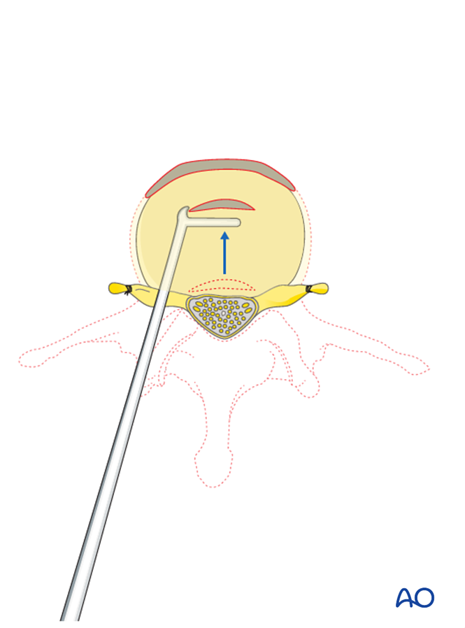 Management of large curves in the spine