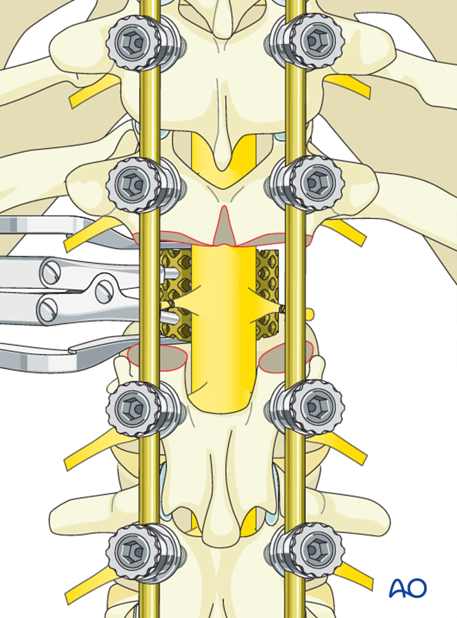 Management of large curves in the spine