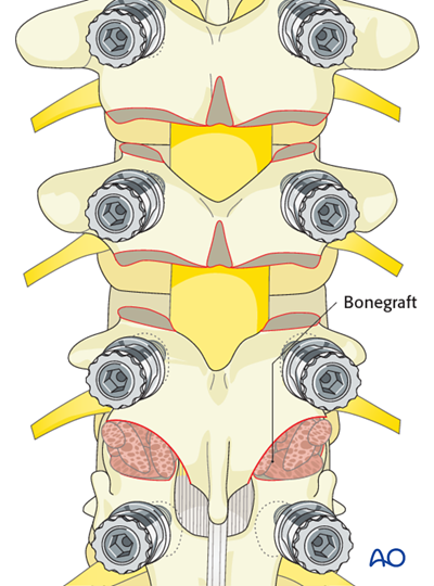 Posterior Screws - With direct vertebral body derotation for Lenke 6