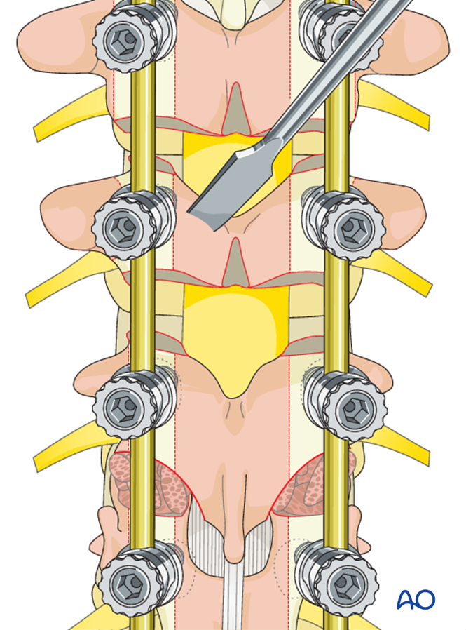 Posterior Screws - With direct vertebral body derotation for Lenke 6