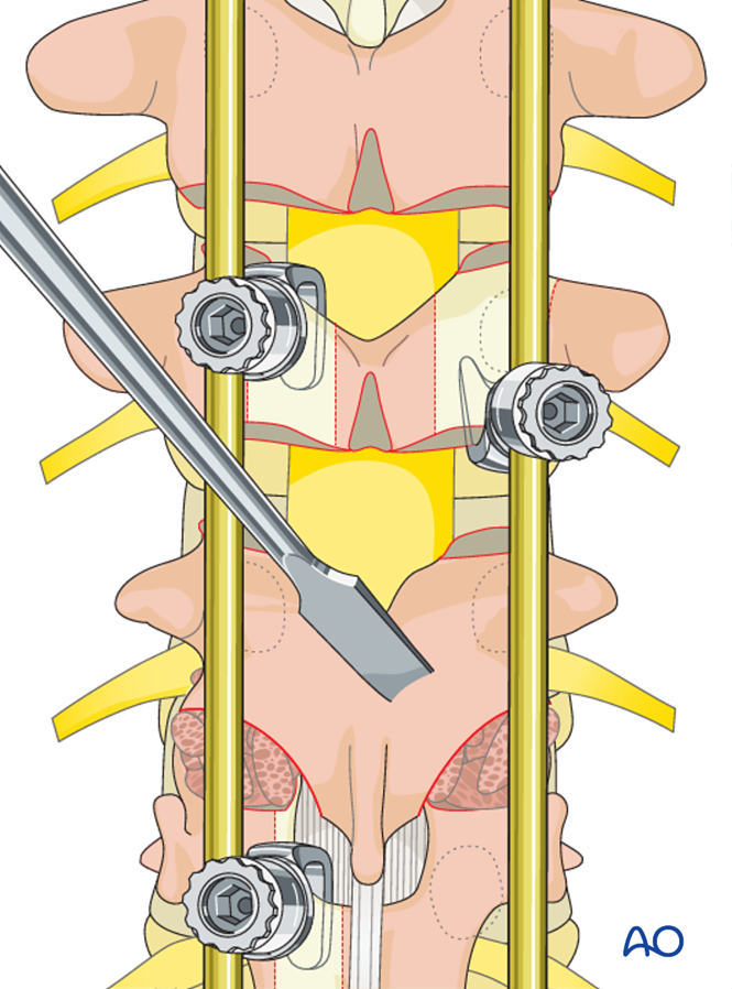 Posterior Hybrid for Lenke 6