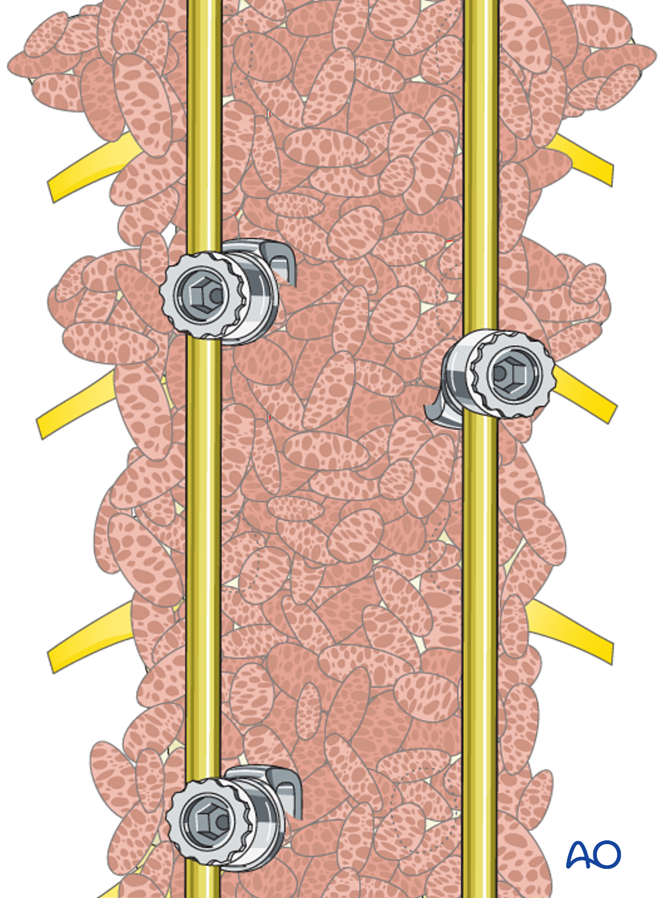 Posterior Hybrid for Lenke 6
