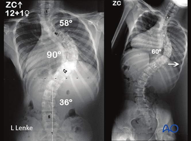 Management of large curves in the spine