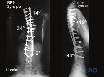 Management of large curves in the spine