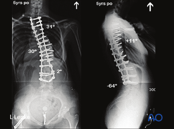 Management of large curves in the spine