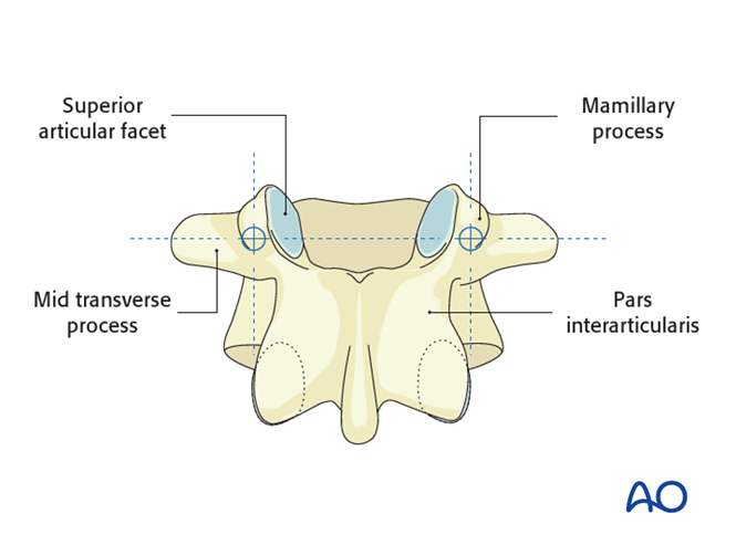 Insertion of pedicle screws