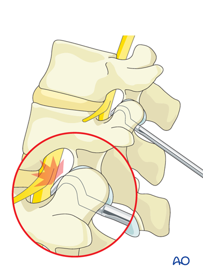 Hook insertion