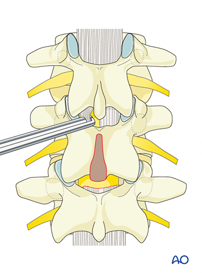 Sublaminar wire insertion