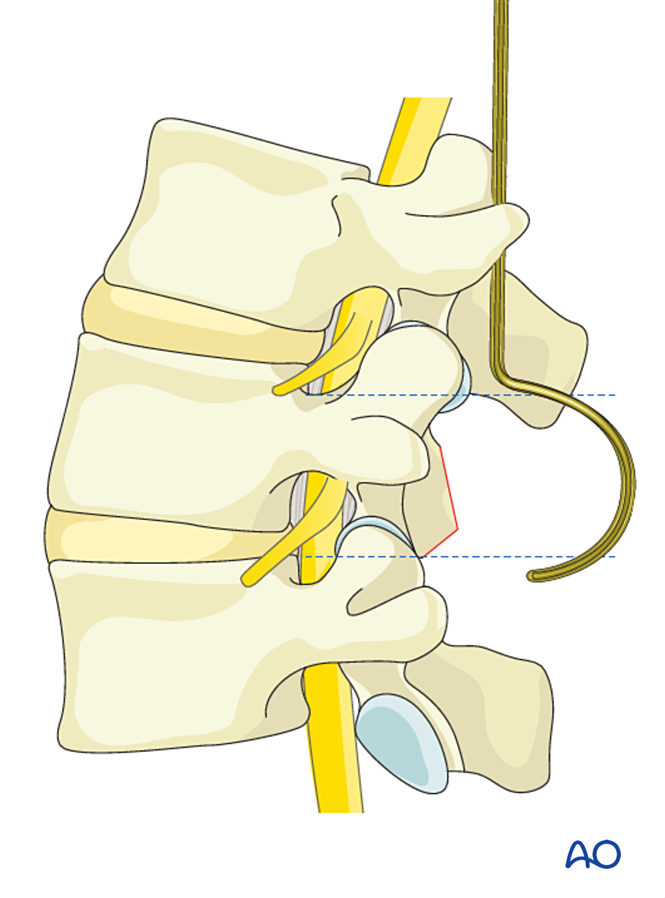 Sublaminar wire insertion