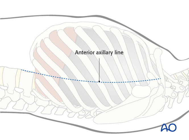 Anterior thoracoscopic release
