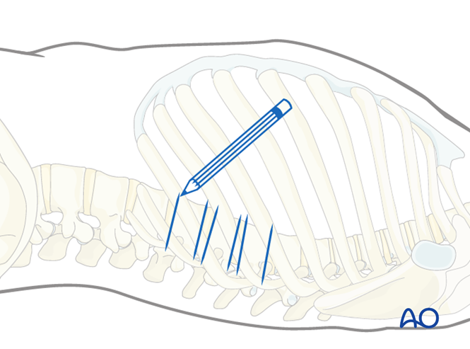 Minimally invasive left side thoracic approach