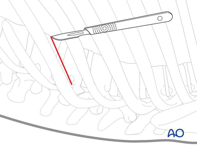 Minimally invasive left side thoracic approach