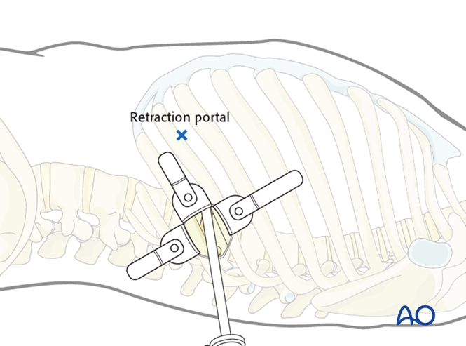 Minimally invasive left side thoracic approach