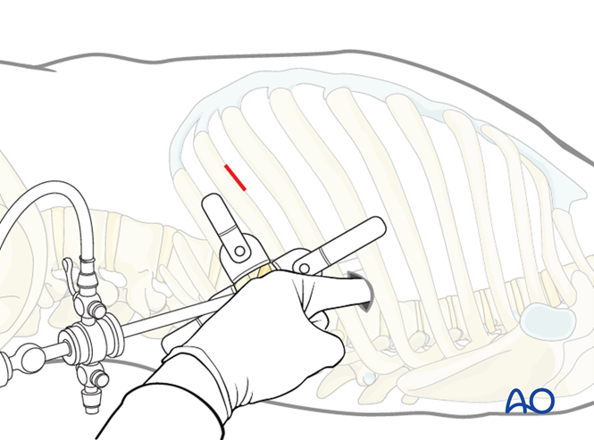 Minimally invasive left side thoracic approach