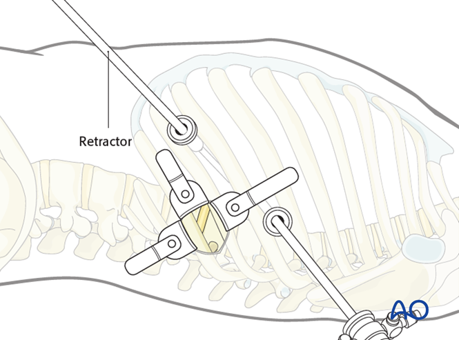 Minimally invasive left side thoracic approach