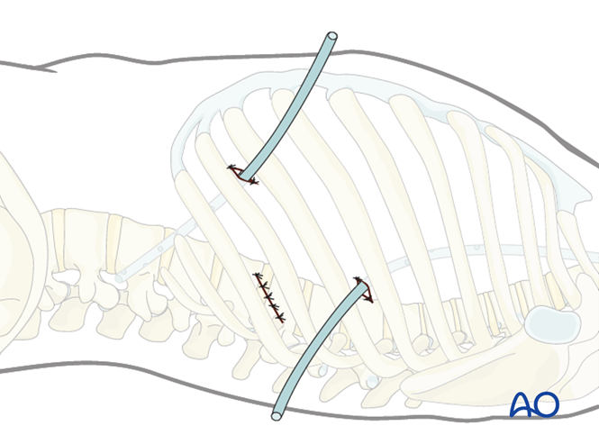 Minimally invasive left side thoracic approach