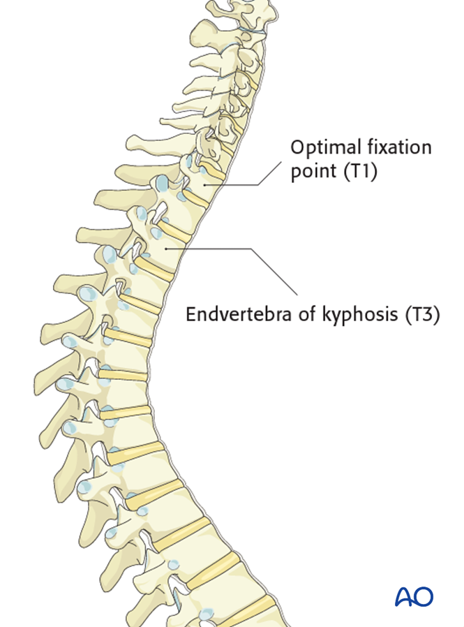 Posterior instrumentation with release for Scheuermann's Kyphosis