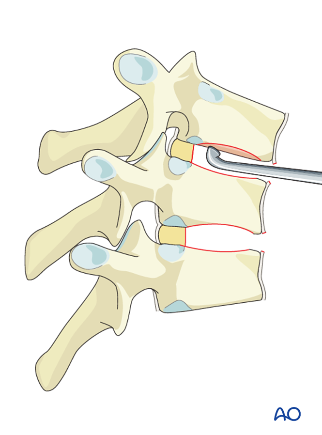 Posterior instrumentation with release for Scheuermann's Kyphosis