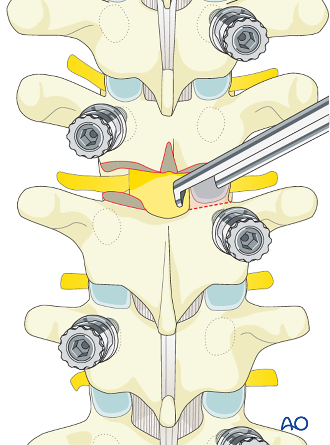 Posterior instrumentation with release for Scheuermann's Kyphosis