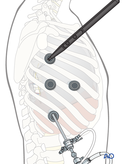 Posterior instrumentation with release for Scheuermann's Kyphosis