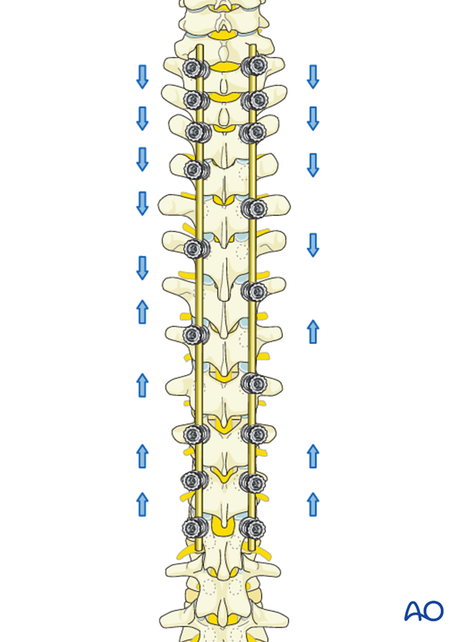 Posterior instrumentation without release for Scheuermann's Kyphosis