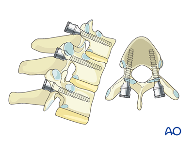 Pedicle screw insertion in the thoracic spine