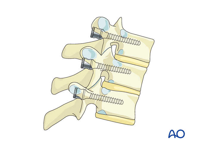 Pedicle screw insertion in the thoracic spine