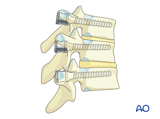 Pedicle screw insertion in the thoracic spine