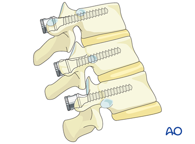 Pedicle screw insertion in the thoracic spine