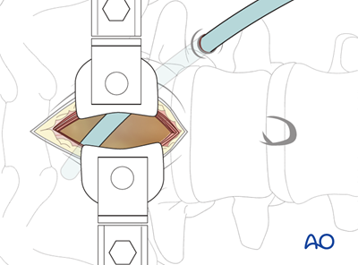 Retroperitoneal approach