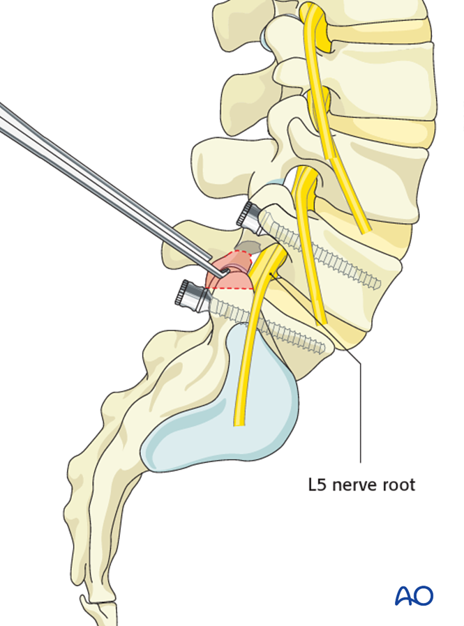 Posterior fusion L5-S1 for Spondylolisthesis - Type 1