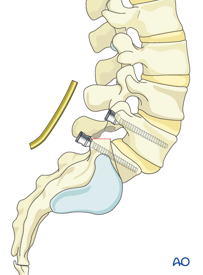 Posterior fusion of L5-S1 for Spondylolisthesis - Type 2