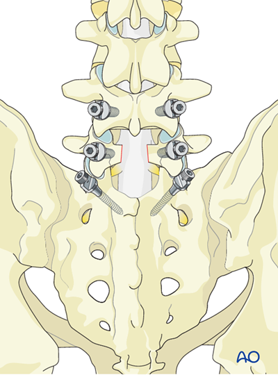 Posterior fusion of L5-S1 for Spondylolisthesis - Type 5