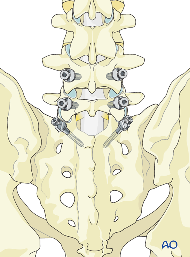 Posterior fusion of L4-S1 (with or without pelvic fixation or ala) for ...