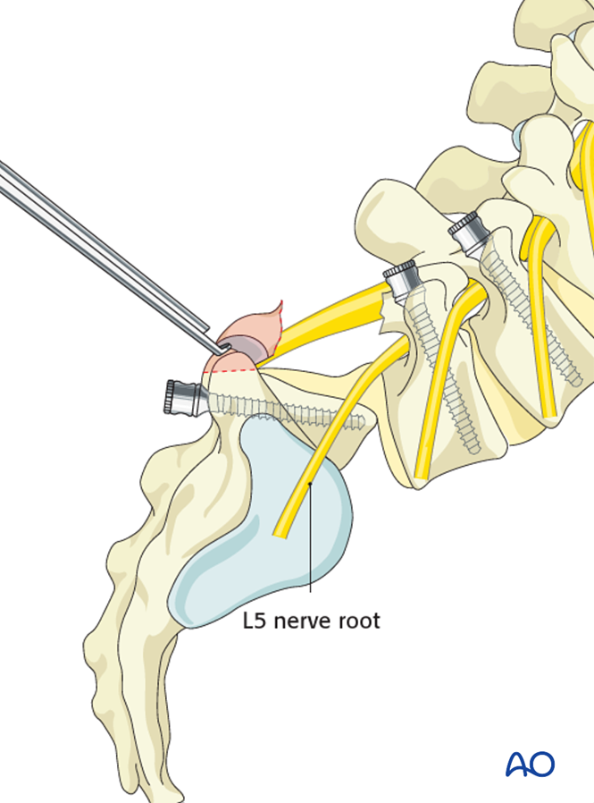 Posterior fusion of L4-S1 (with or without pelvic fixation or ala) for ...