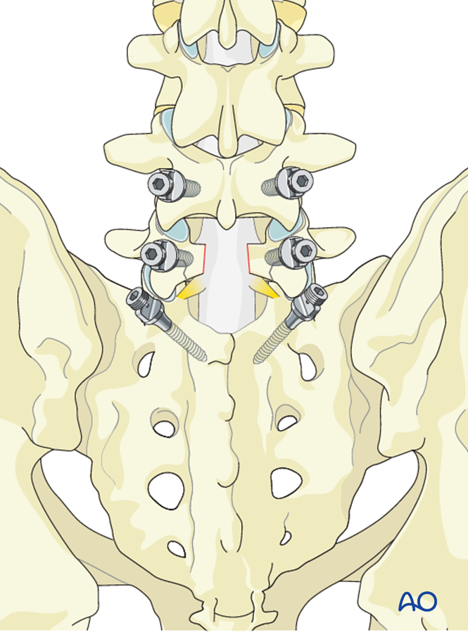 Posterior fusion of L4-S1 (with or without pelvic fixation or ala) for ...