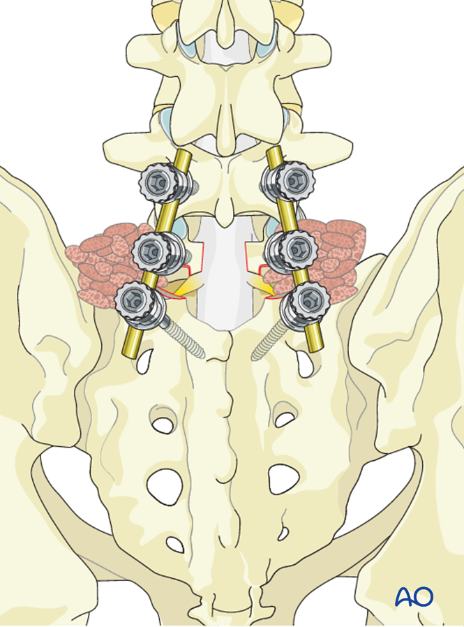 Posterior fusion of L5-S1 for Spondylolisthesis - Type 5