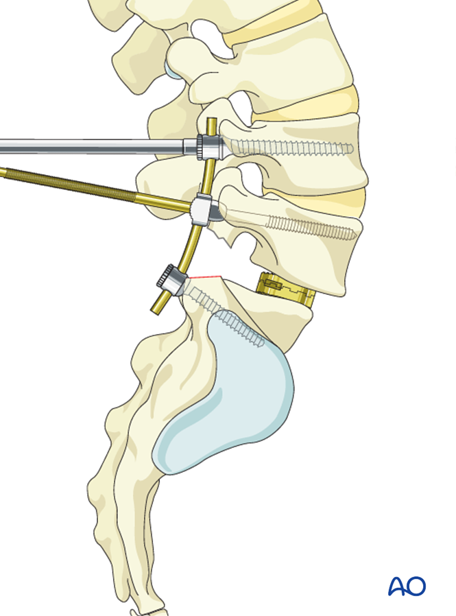 Posterior fusion of L4-S1 (with or without pelvic fixation or ala) for ...
