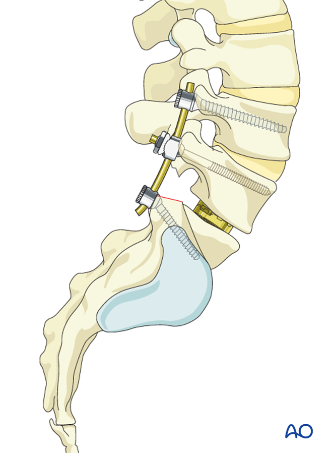 Posterior fusion of L4-S1 (with or without pelvic fixation or ala) for ...